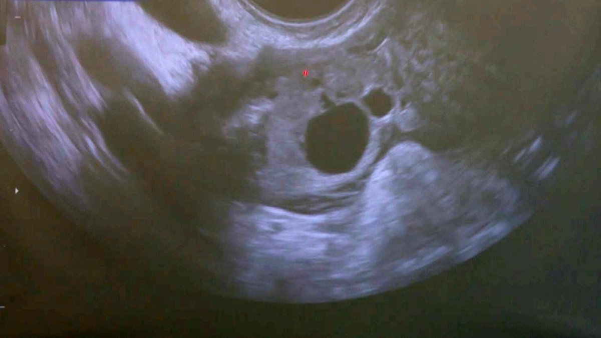 VFN: Nejpřesnější vyšetření u rakoviny vaječníků je ultrazvuk. Probíhá v reálném čase | TN.cz