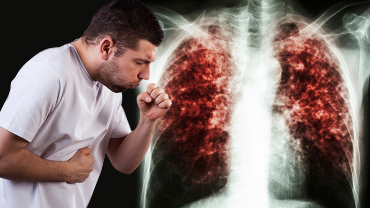 Tuberkulóza v ČR po krajích: Kolik nakažených hlásí u vás? PŘEHLED | TN.cz